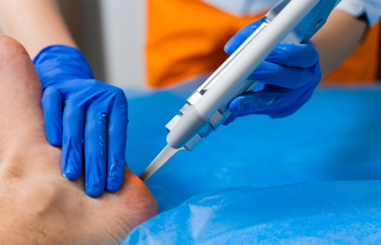 Pourquoi vos verrues persistent malgré les traitements? 👣